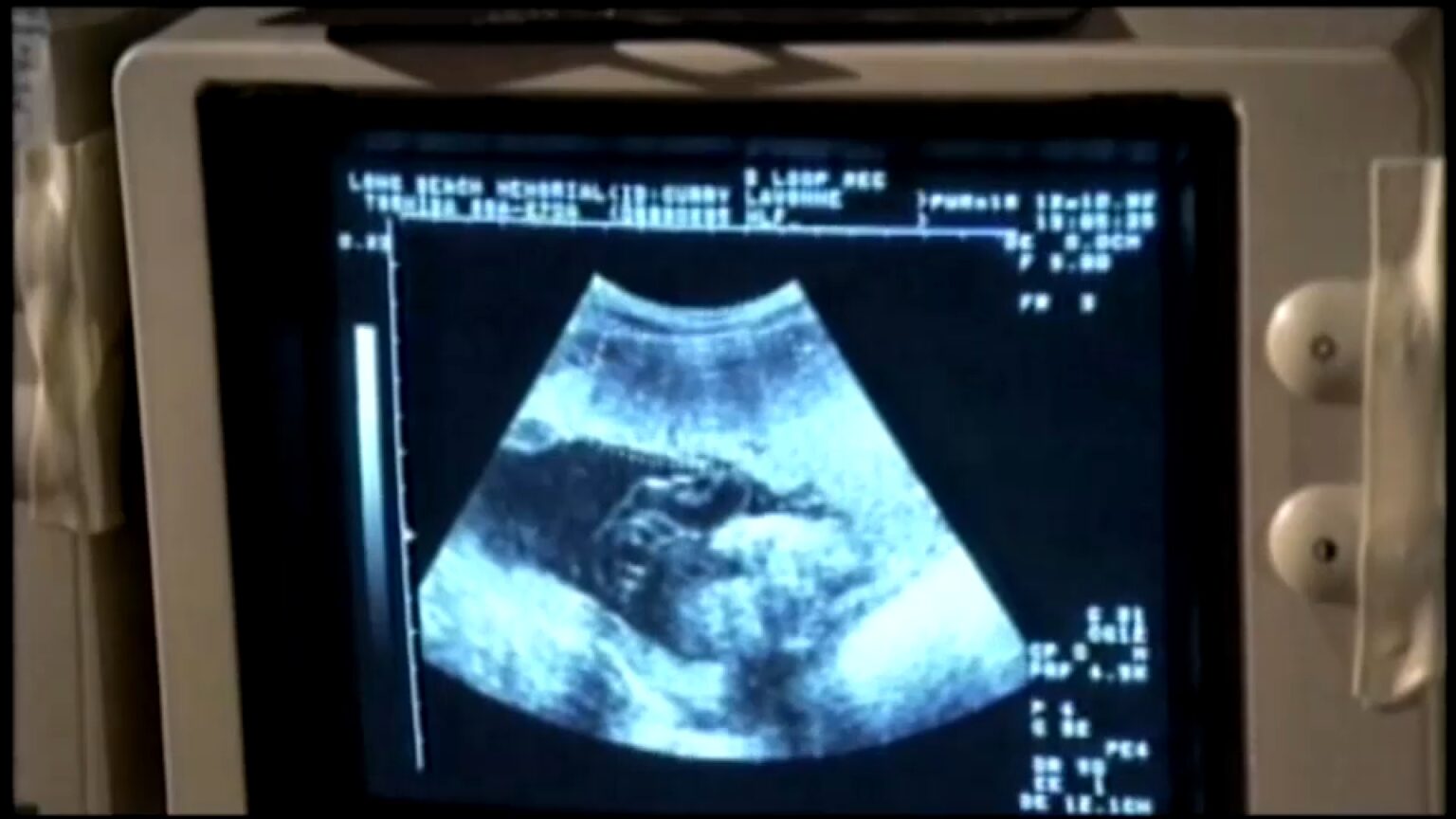 Columbia University Unveils Tech to Combat Preterm Birth Risks