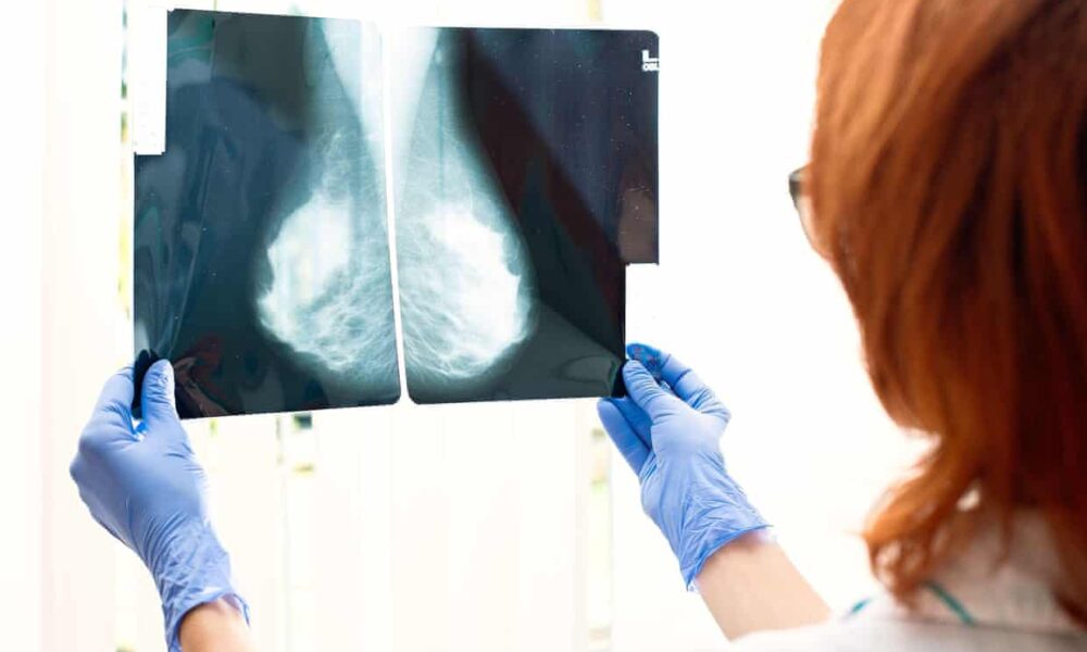 Simple Blood Test Predicts Best Breast Cancer Treatments